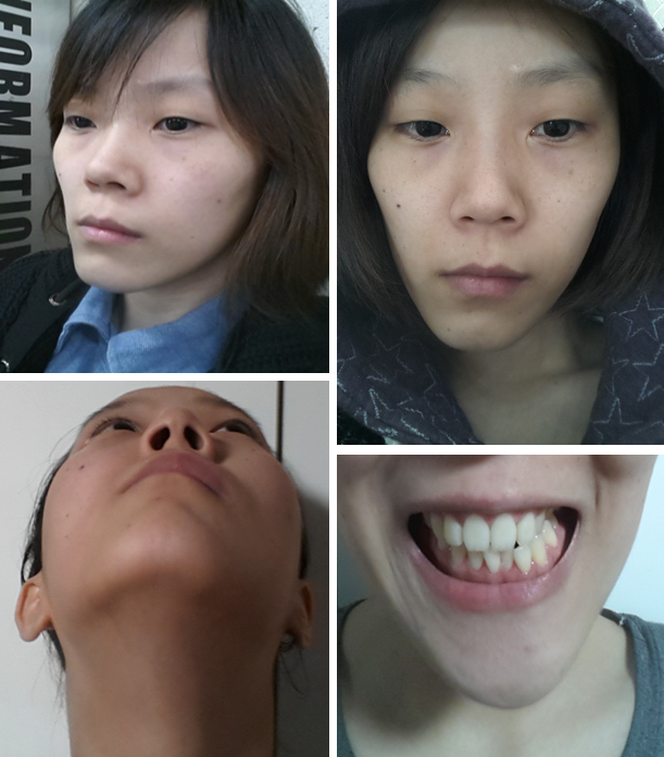 ID Hospital Korea: [Real Review] How I corrected my facial asymmetry ...