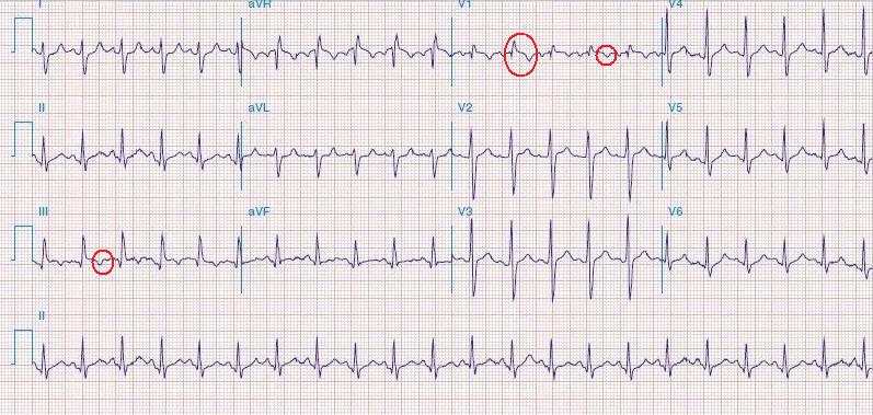 Cardiopneumologia: ECG - TROMBOEMBOLISMO PULMONAR (TEP)
