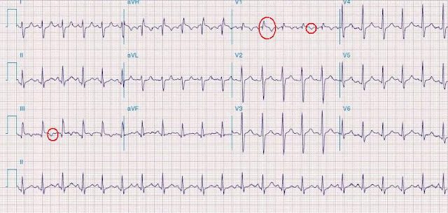 Cardiopneumologia: ECG - TROMBOEMBOLISMO PULMONAR (TEP)
