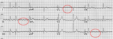 Notas de Medicina Familiar: ECG: Flutter auricular