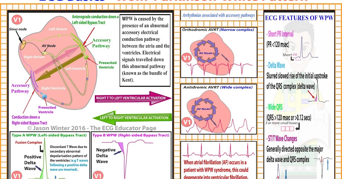 The ECG Educator Blog : Wolff-Parkinson-White