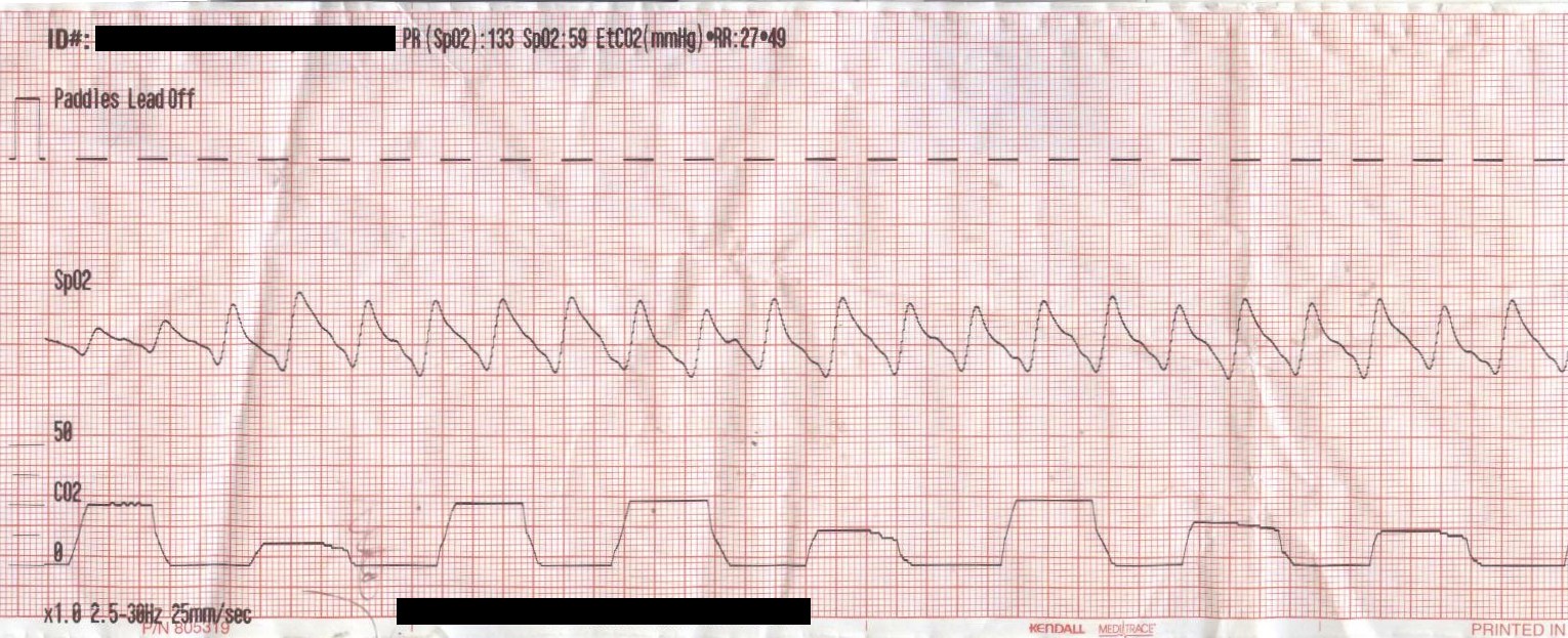 differentiating cardiac wheeze vs. obstructive airway wheeze using ...