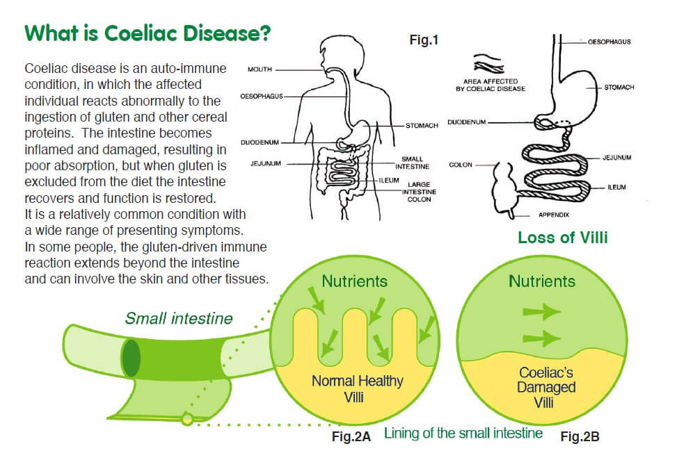 The Health Website : Coeliac disease