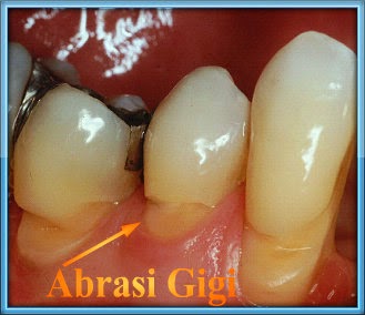 Kesehatan Gigi dan Mulut: ABRASI GIGI