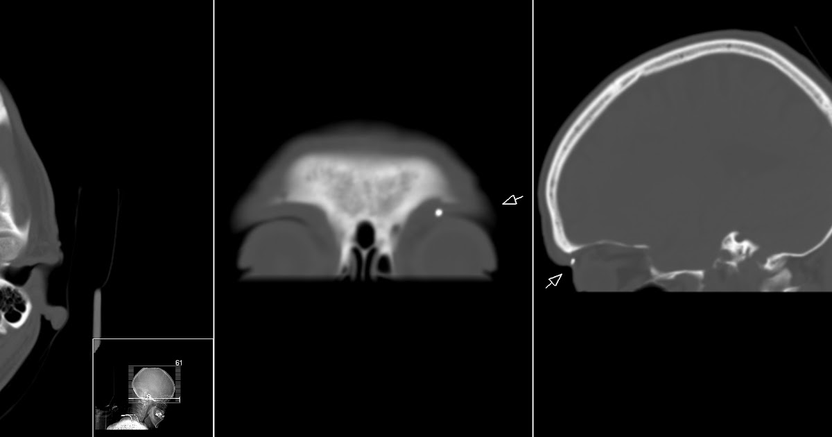 Radiology MRI: MRI - Metal Screening