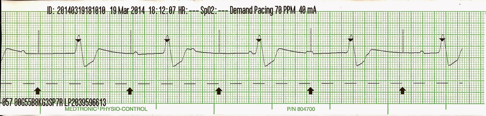 EKG Rhythm Quiz 218