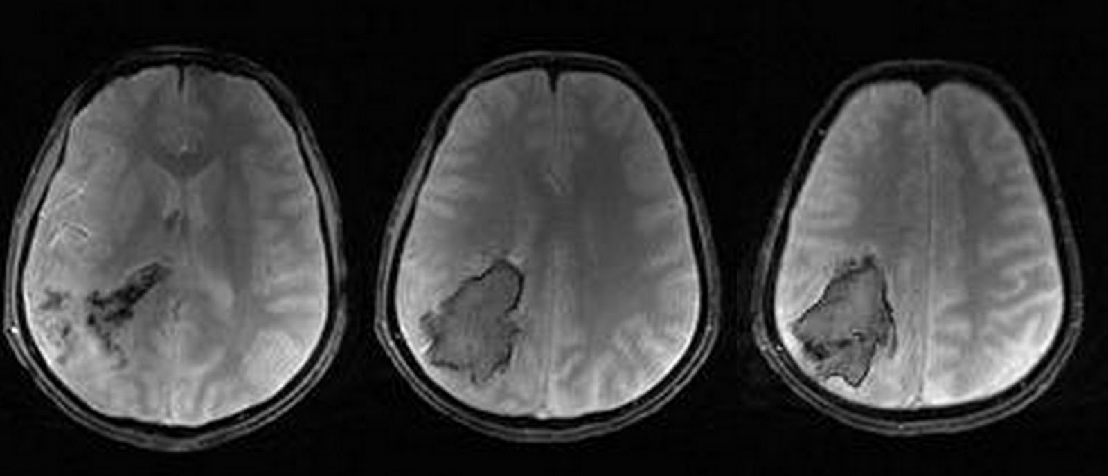 Dr Balaji Anvekar FRCR: Secondary Intracerebral Hemorrhage