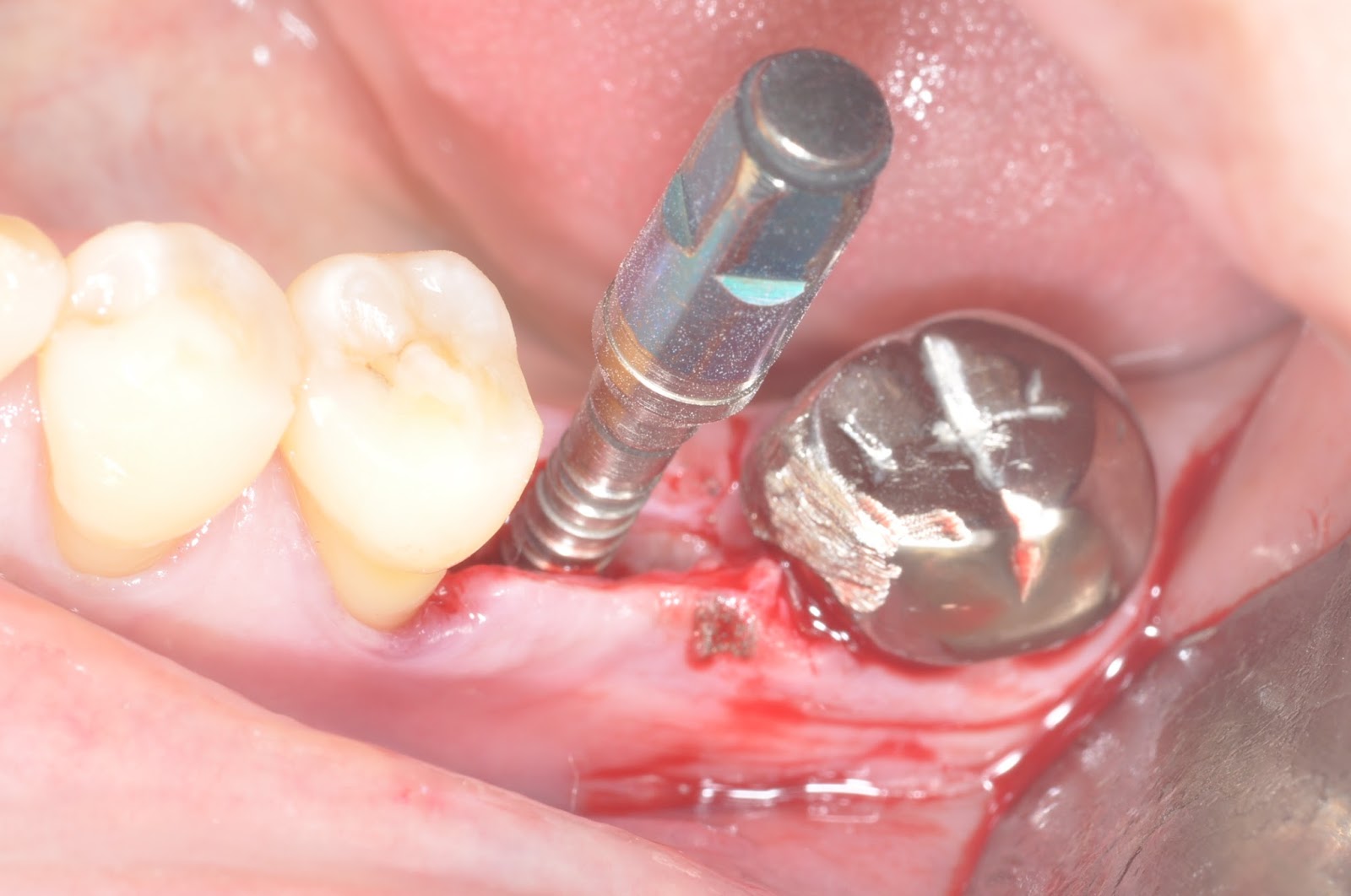Dental Implant Narrow Ridge at William Swoope blog