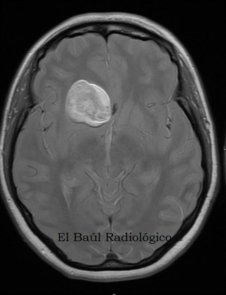 El Baúl Radiológico: 2) QUISTE DERMOIDE INTRACRANEAL (Intracranial ...