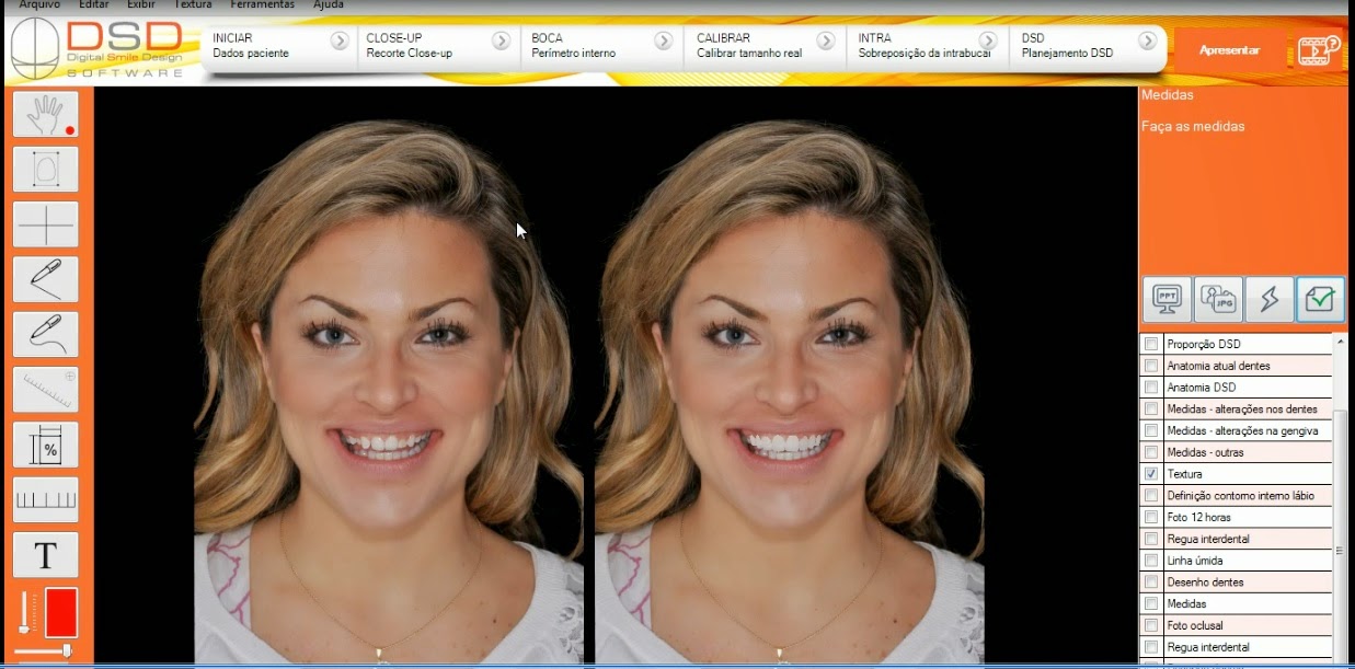 Implantes Dentais e Estética Dental: PLANEJAMENTO DIGITAL DO SORRISO - DSD