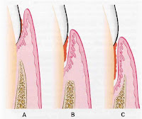 Poket Periodontal - Terkadang, ada hal yang hanya dapat diungkapkan ...
