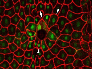 Get Rid of Acne Overnight and Forever: Epitheialization and Acne Scar