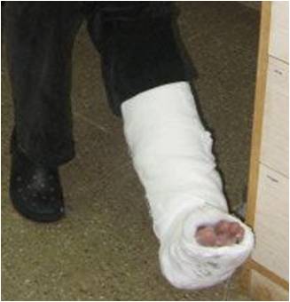 In a Cast / The long journey after a ligament tear: Day 1 : Browse the web