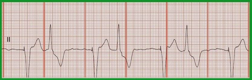 Various Bigeminal PVCs