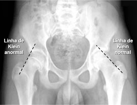 Epifisiólise proximal do fêmur (EPF)