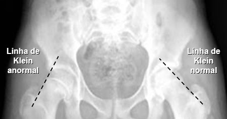 Epifisiólise proximal do fêmur (EPF)