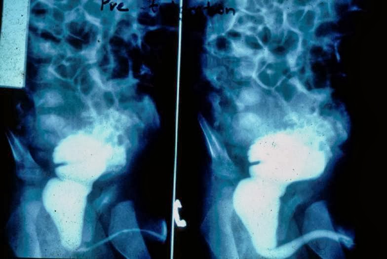 Kuching Urology古晉秘尿專科: PUV posterior urethral valve