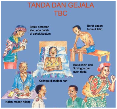 Tanda dan Gejala penyakit Tuberkulosis