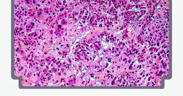 Pathology Infographics : Epithelioid Schwannoma - A rare variant of ...