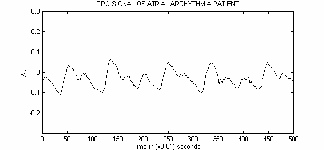 finger pulse signal detection and recording using labview