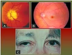 Enfermedades causadas por el mal funcionamiento de la mitocondria ...