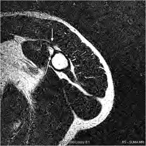 Long head of Biceps Rupture-MRI - Sumer's Radiology Blog