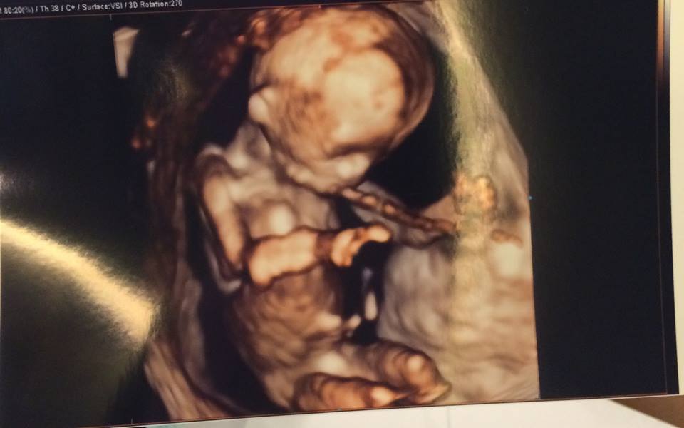 -weEp-'s pregnancy diary!: 5D Ultrasounds