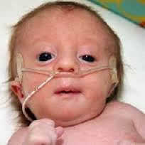 Medical Treatment Pictures-for Better Understanding: Edwards Syndrome