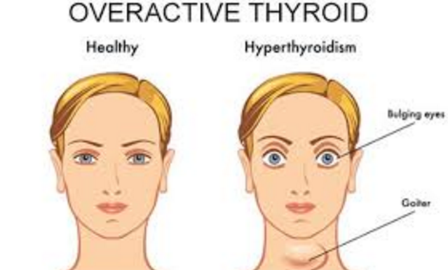 Ayurveda Home and Remedies with Nature: घेंघा रोग कैसे होता है ,Ghengha ...