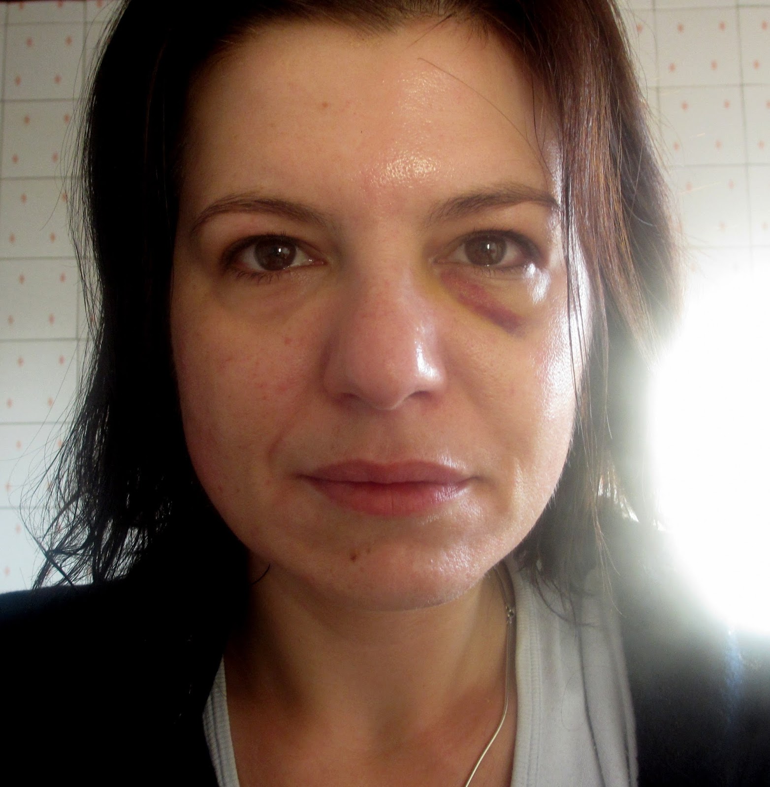 Dear Skin: LIPOGEMS TRETMAN AUTOLOGNIH MATIČNIH STANICA IZ MASNOG TKIVA