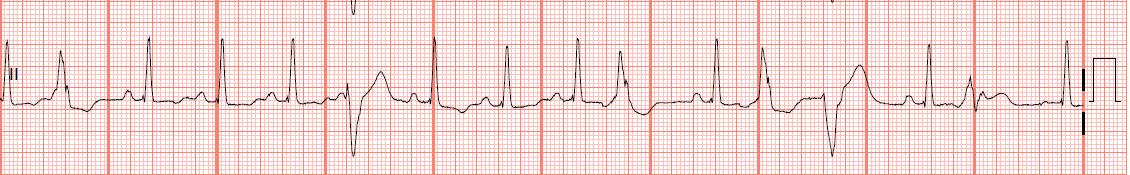 EKG Rhythm Strips 37