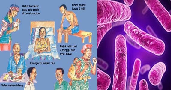 Jenis Obat paru paru tuberculosis dan pernafasan