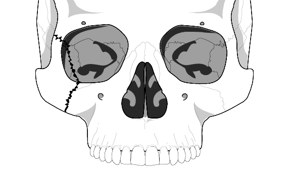 WizDent: Facial and Mandibular Fractures