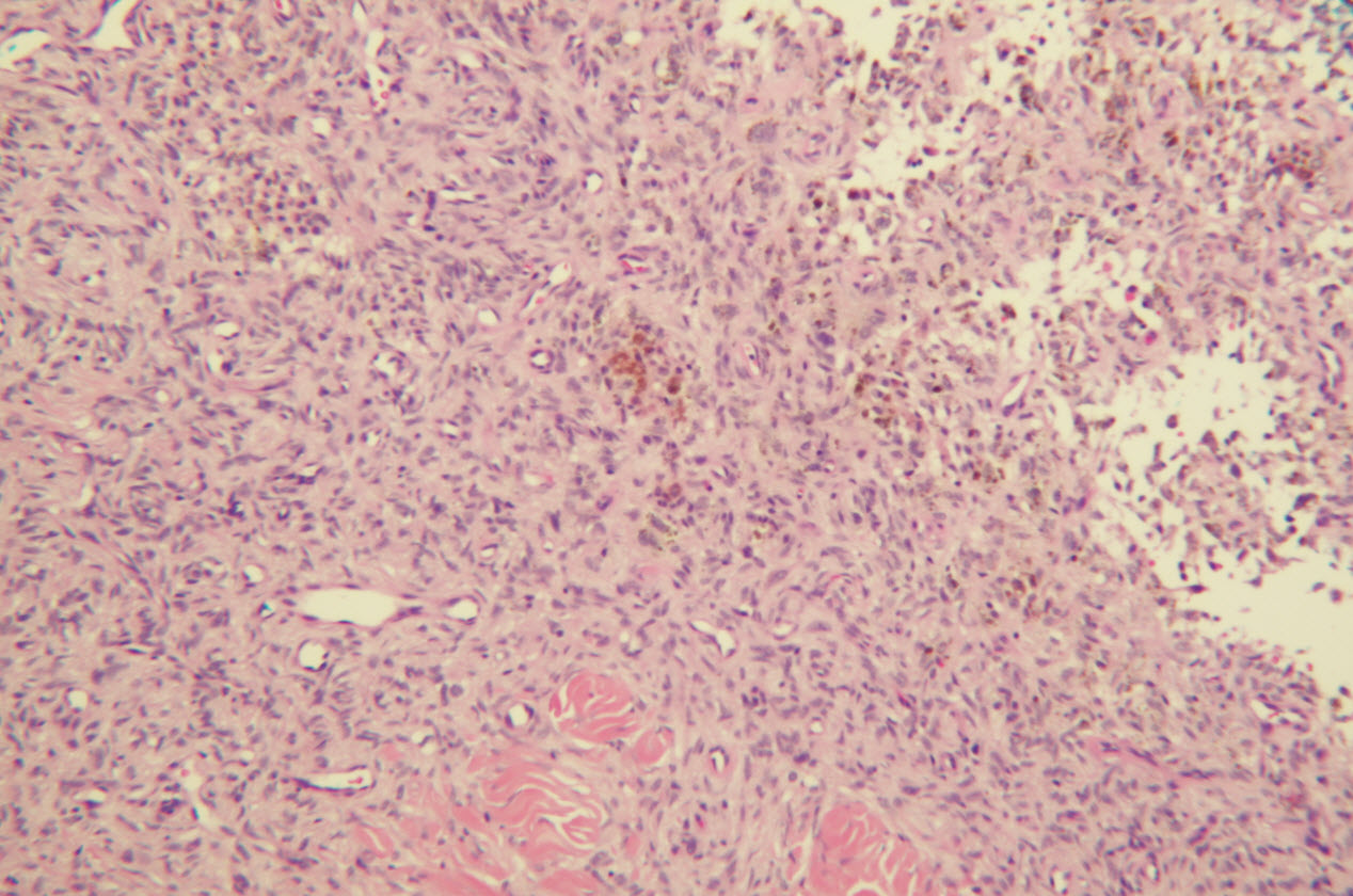Dermpath Made Simple - Neoplastic: Dermatofibroma