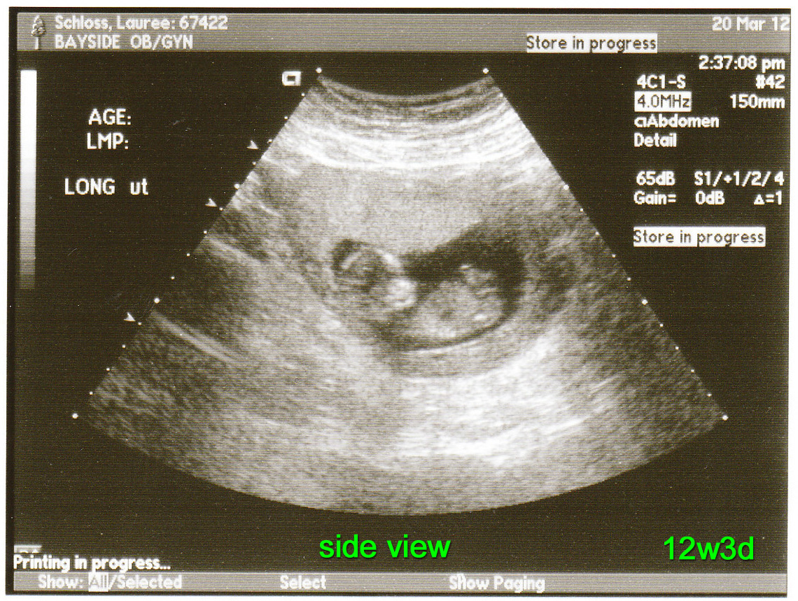 Just Relax and It Will Happen: 12w3d - NT Scan ultrasound
