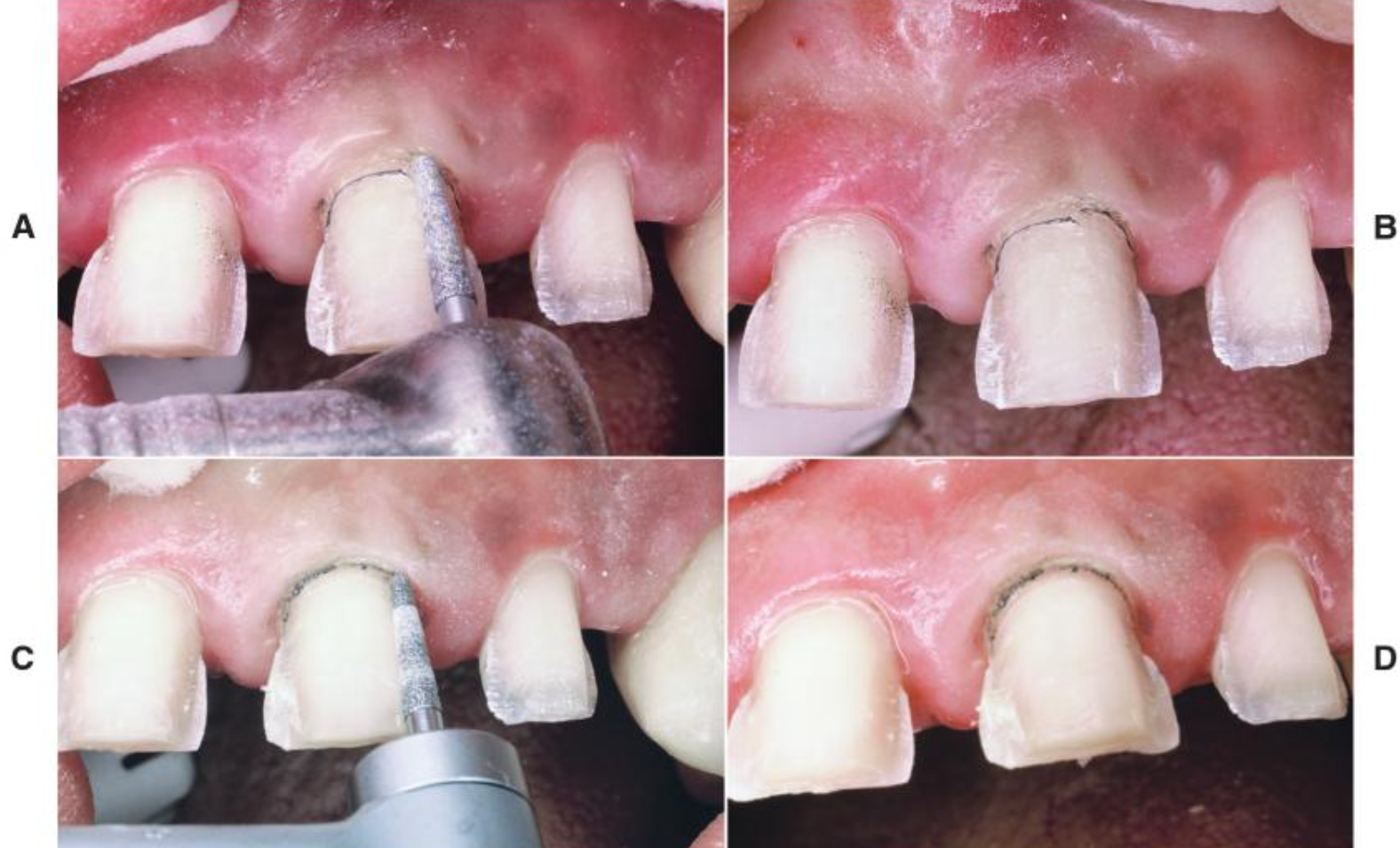 Odontology Student: Prosthodontics: The Metal-Ceramic Crown Preparation ...