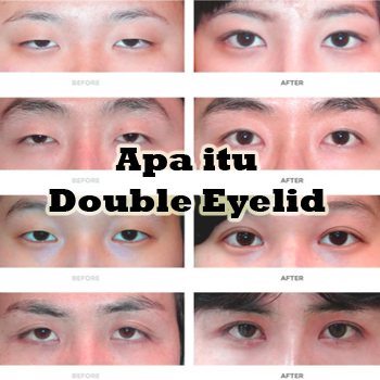 Pengertian dari Double Eyelid