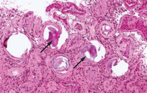 Microlitiasis Testicular