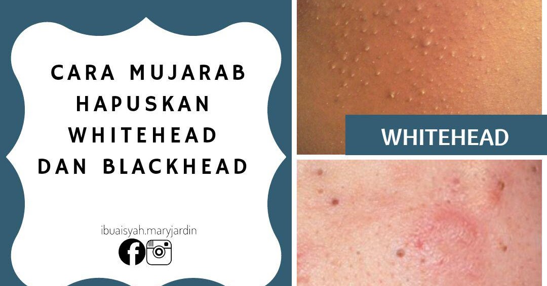 TIPS:"Cara mujarab hapuskan whitehead dan blackhead" - Mary Jardin By ...