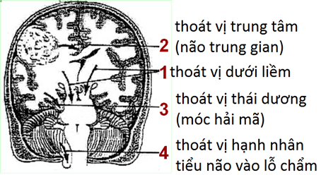 học Y: hội chứng tăng áp lực nội sọ