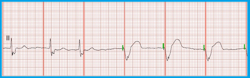 Practice EKG Rhythm Strips 191