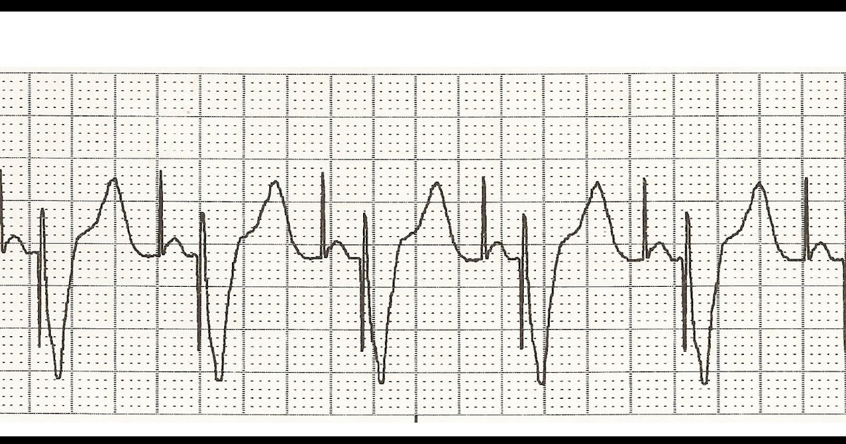 Float Nurse: EKG Rhythm Strip Quiz 155