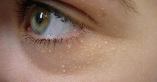 7 ways to get rid of cholesterol milk spots naturally