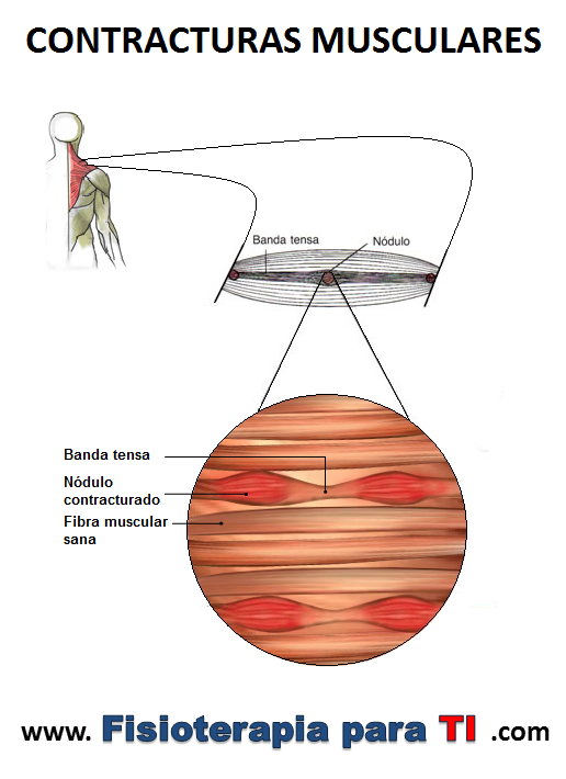 Fisioterapia para TI: ¿QUÉ ES UNA CONTRACTURA MUSCULAR?