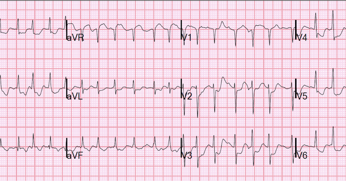 Dr. Smith's ECG Blog: Cardiac arrest, defibrillated, diffuse ST ...