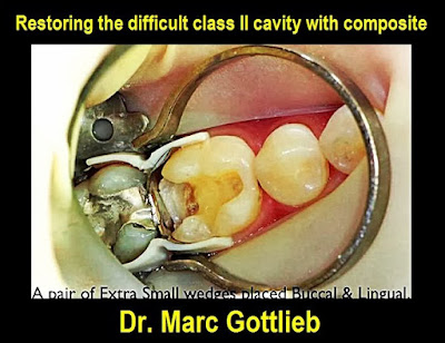 OPERATIVE DENTISTRY: Restoring the difficult class II cavity with ...