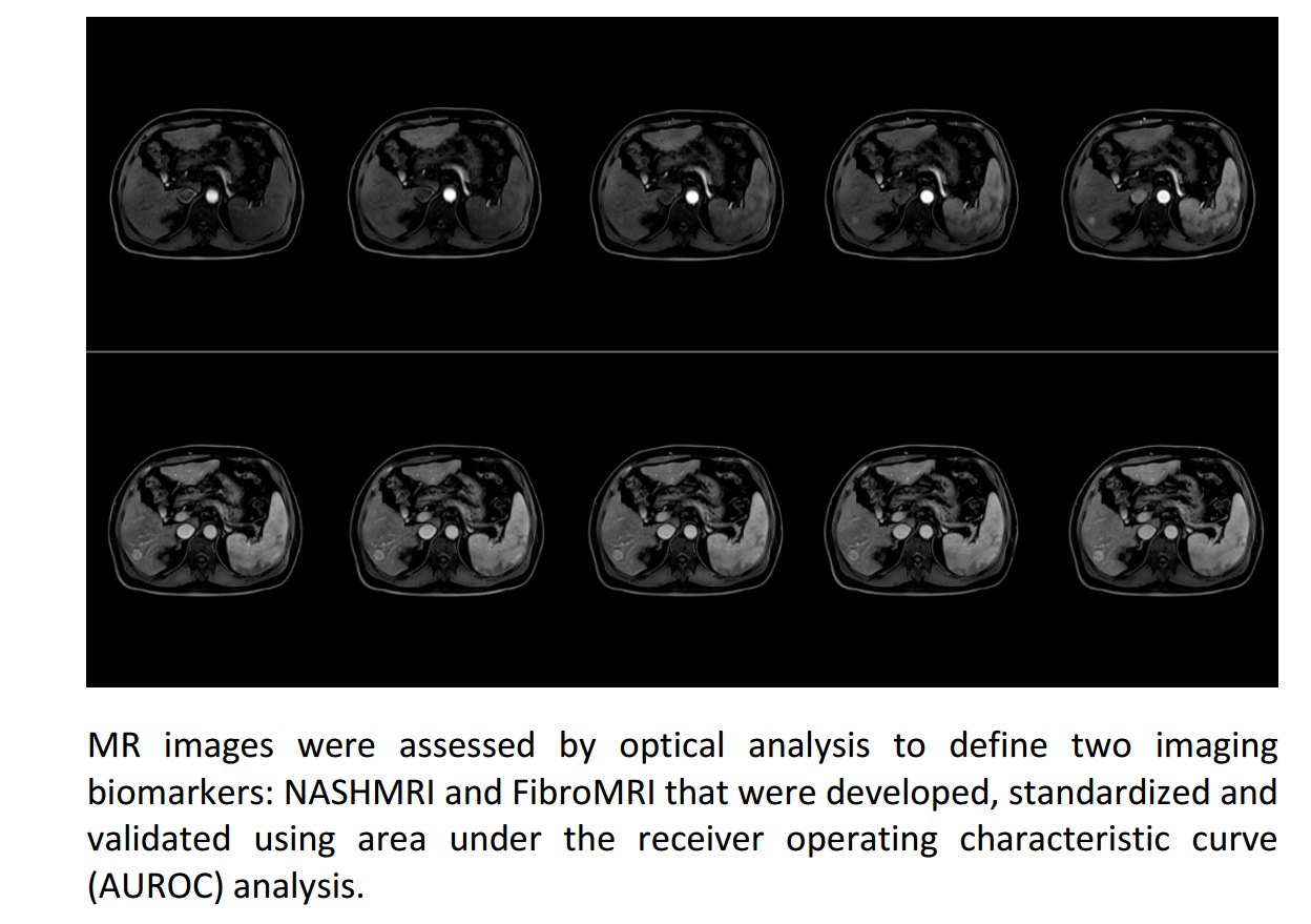Optical Analysis for NASH Diagnosis on Liver MRI - Sumer's Radiology Blog