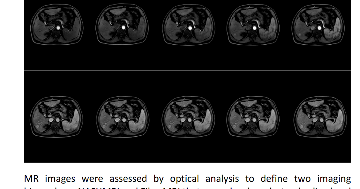 Optical Analysis for NASH Diagnosis on Liver MRI - Sumer's Radiology Blog