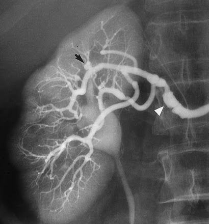 The Pump and the Tubes: The Vasculitides: Polyarteritis Nodosa