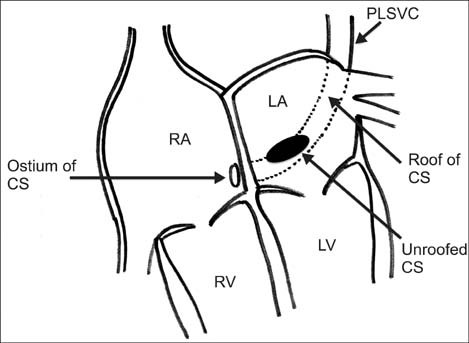 CVT Mohd Farid: Unroofed Coronary Sinus